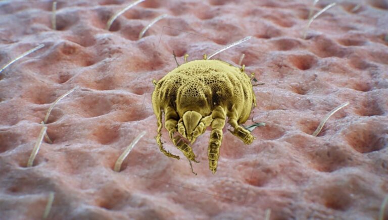 Scabies What Are They and Where Do They Come From? | Natural ...